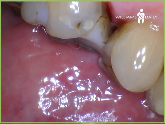 What does a cavity look like?