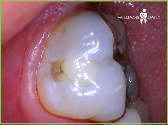 What does a cavity look like?